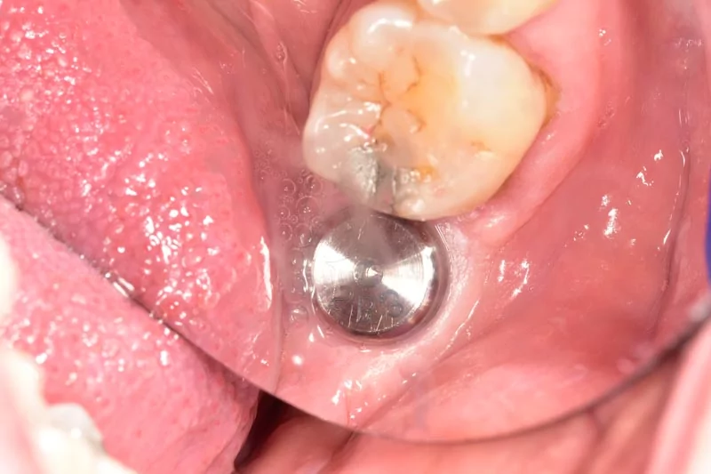 The Implant Hub from Biohorizons