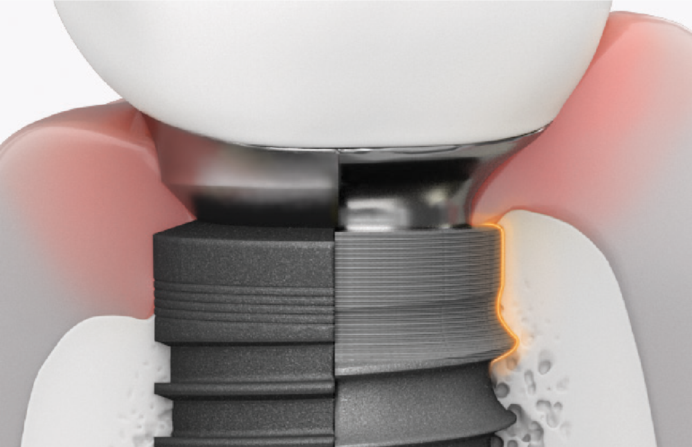 Tapered Pro Conical - The Implant Hub from Biohorizons